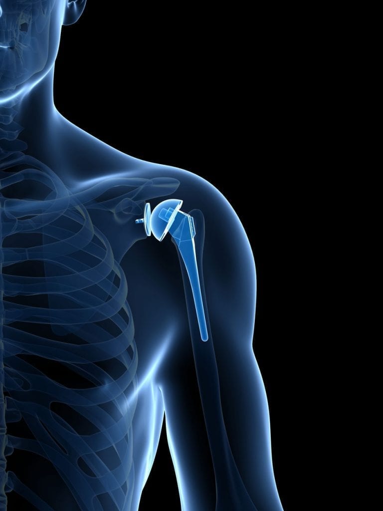 Total Shoulder Replacement | Pinehurst Surgical Clinic