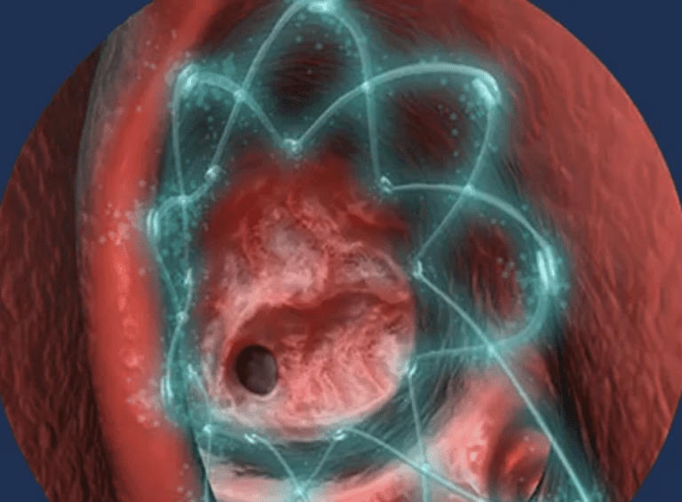 PROPEL Sinus Stent | Pinehurst Surgical Clinic