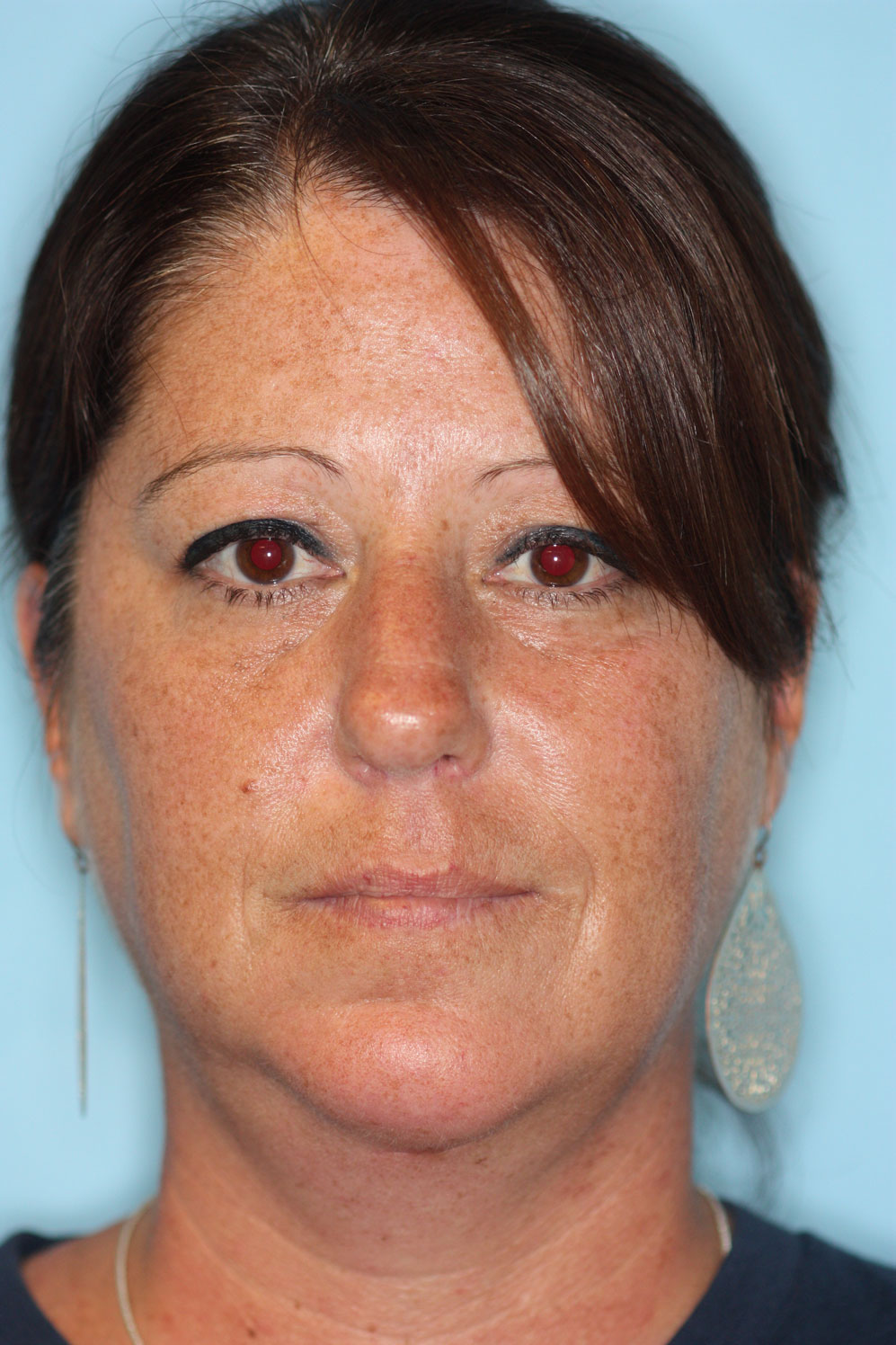 Chin Augmentation | Pinehurst Surgical Clinic