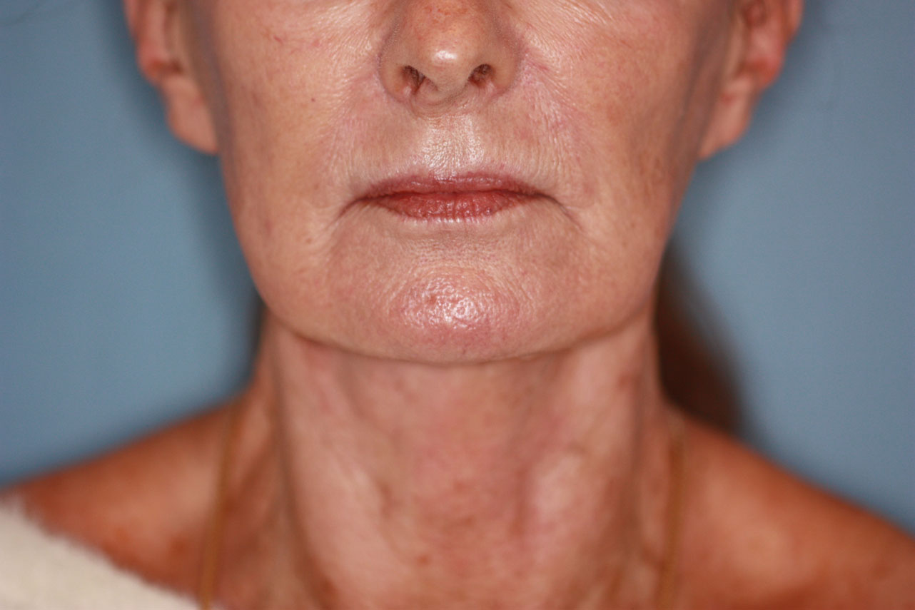 Profound | Pinehurst Surgical Clinic