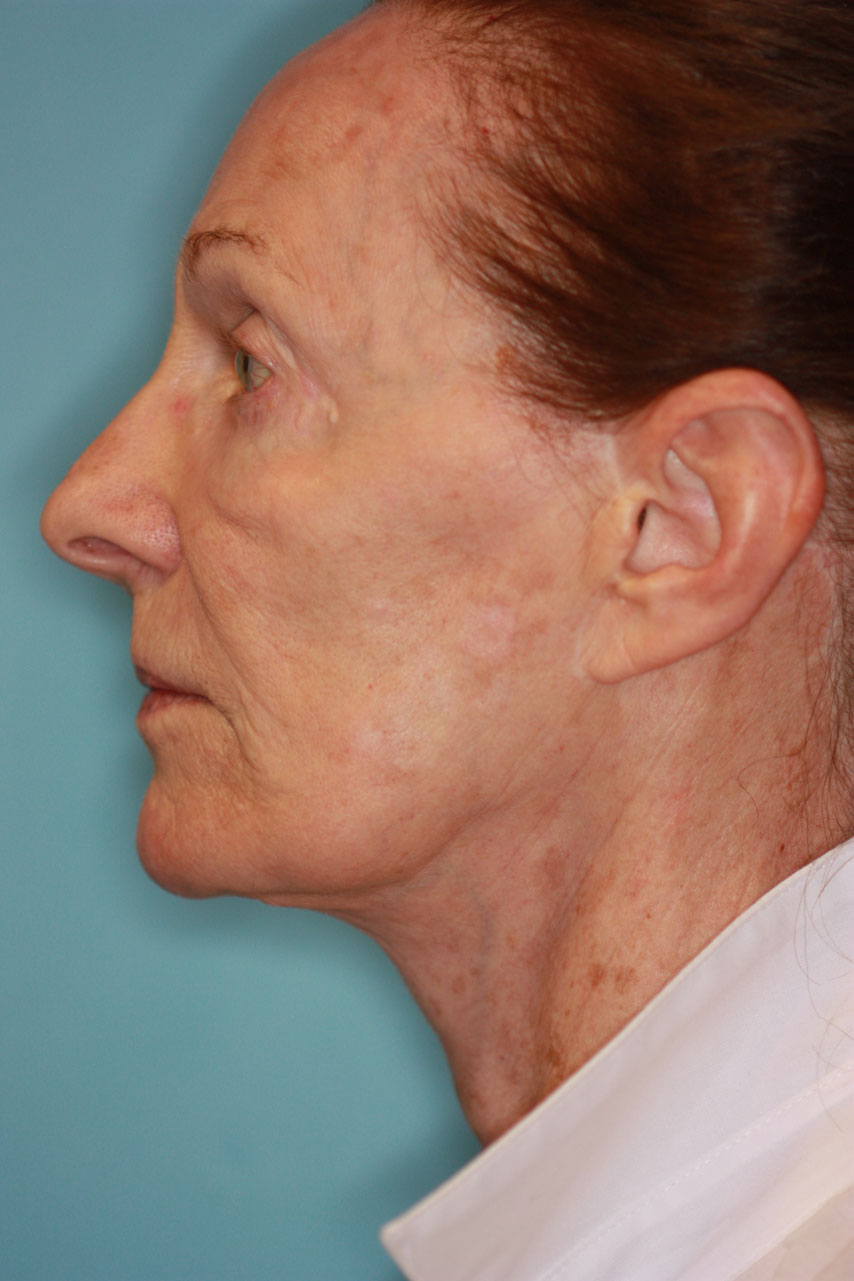 Profound | Pinehurst Surgical Clinic