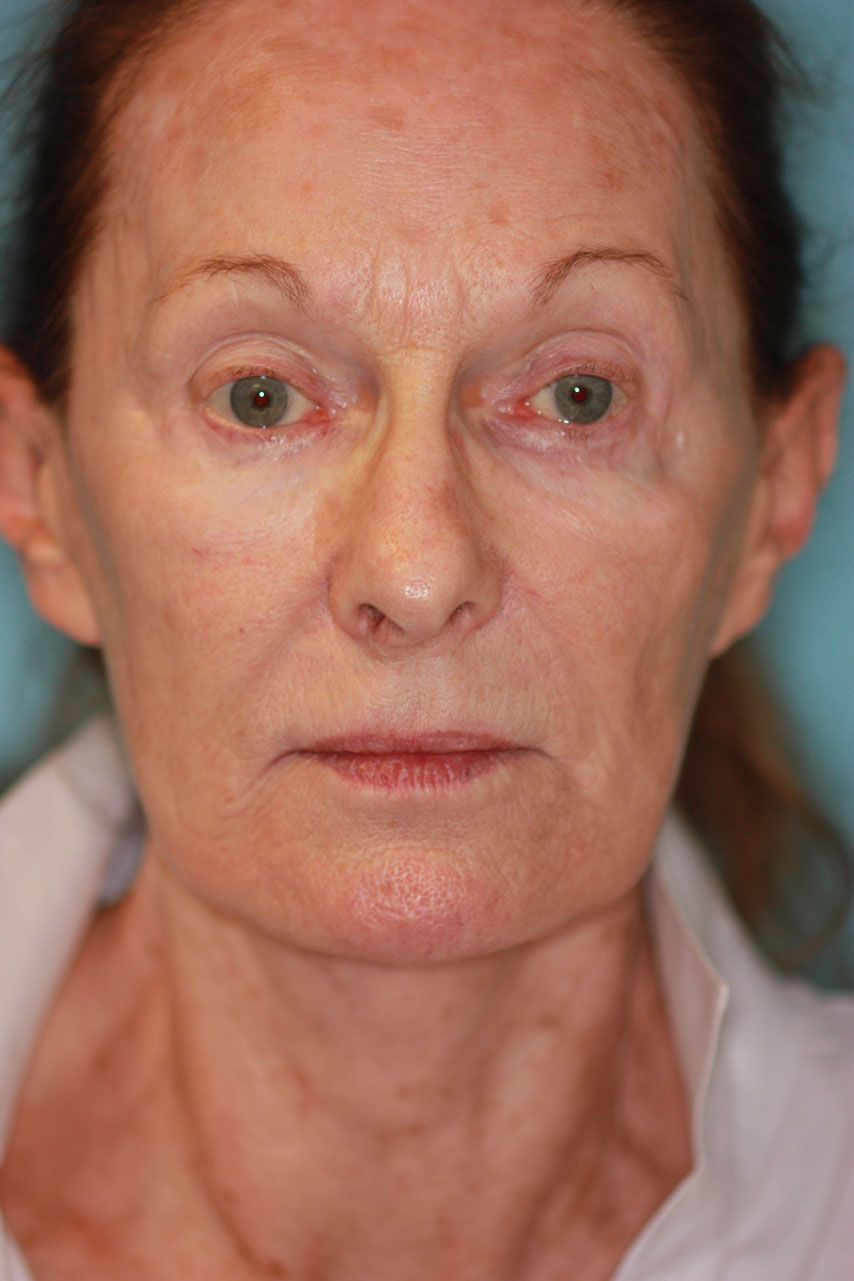 Profound | Pinehurst Surgical Clinic